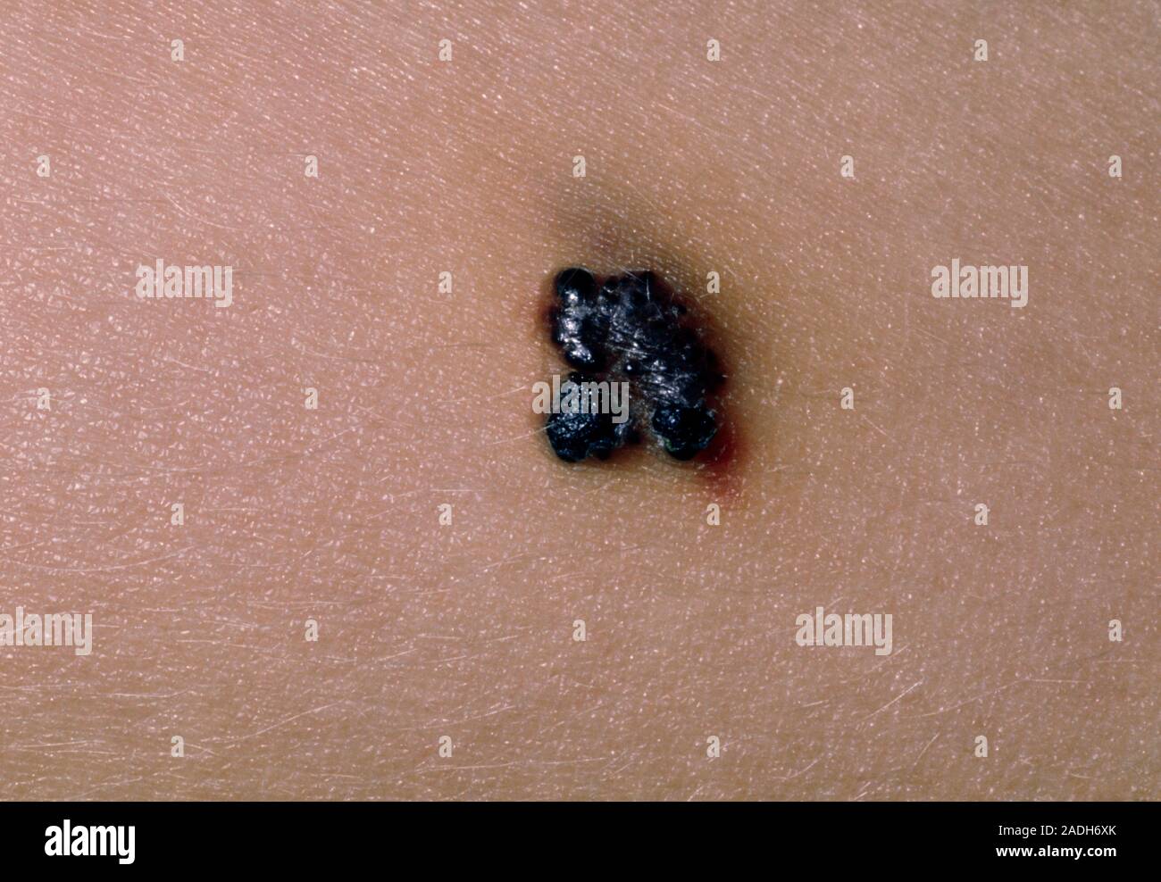 Angiokeratoma. Dark black benign tumour seen on the skin of a 12 year ...
