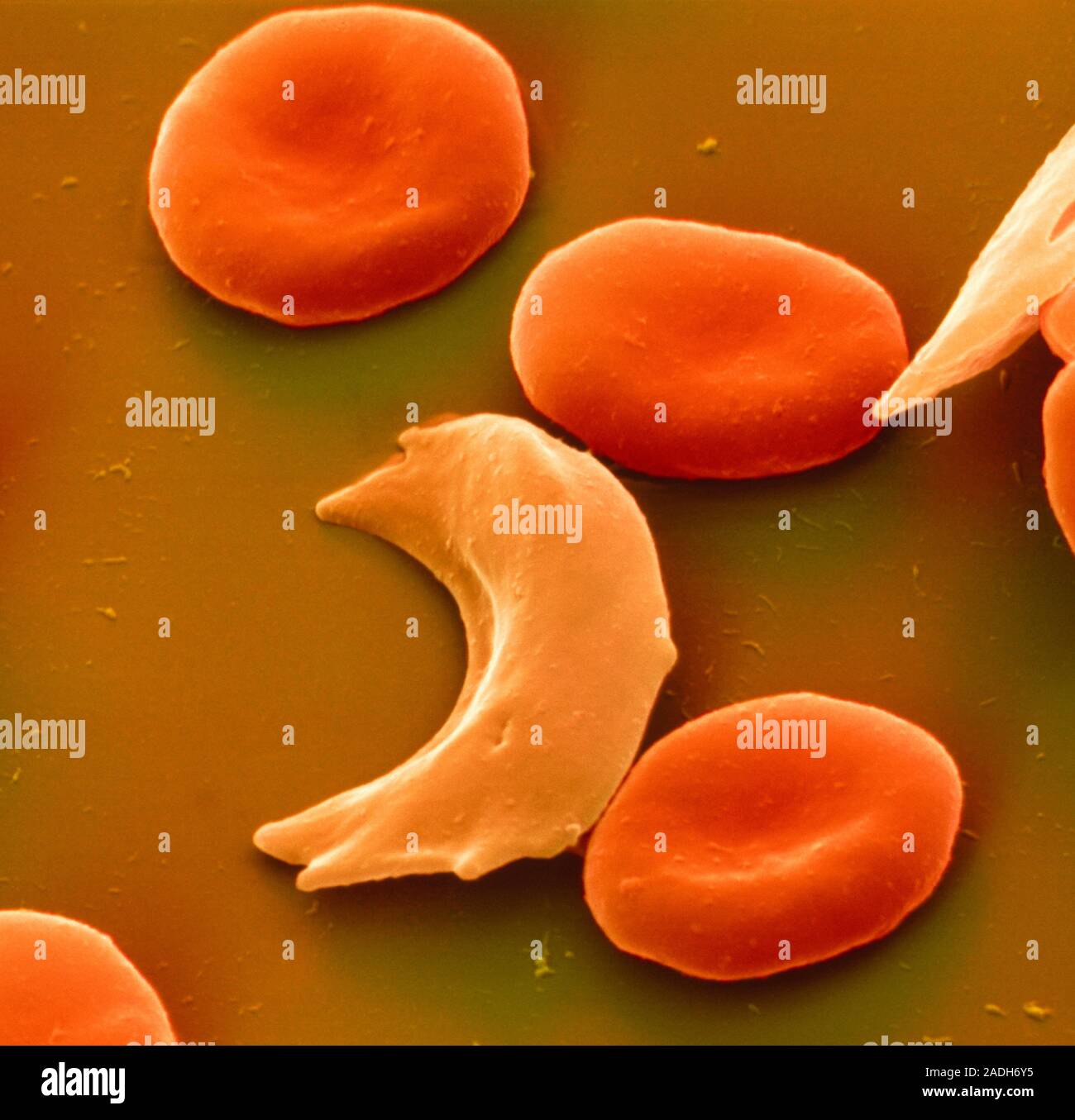 Sickle cell anaemia. Coloured scanning electron micrograph (SEM) of red ...