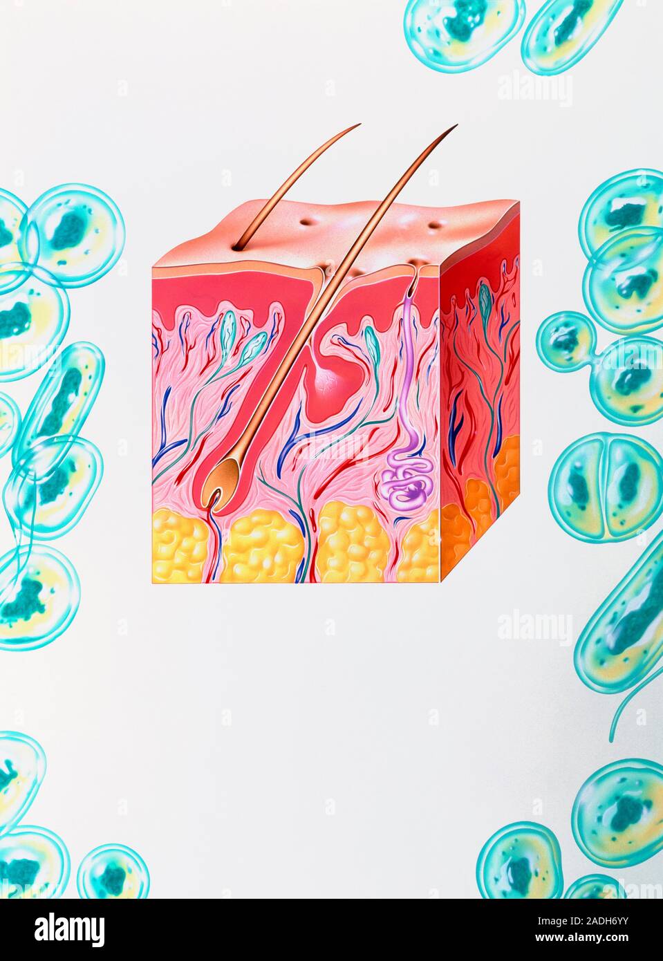 Acne. Artwork showing a section of human skin surrounded by skin ...