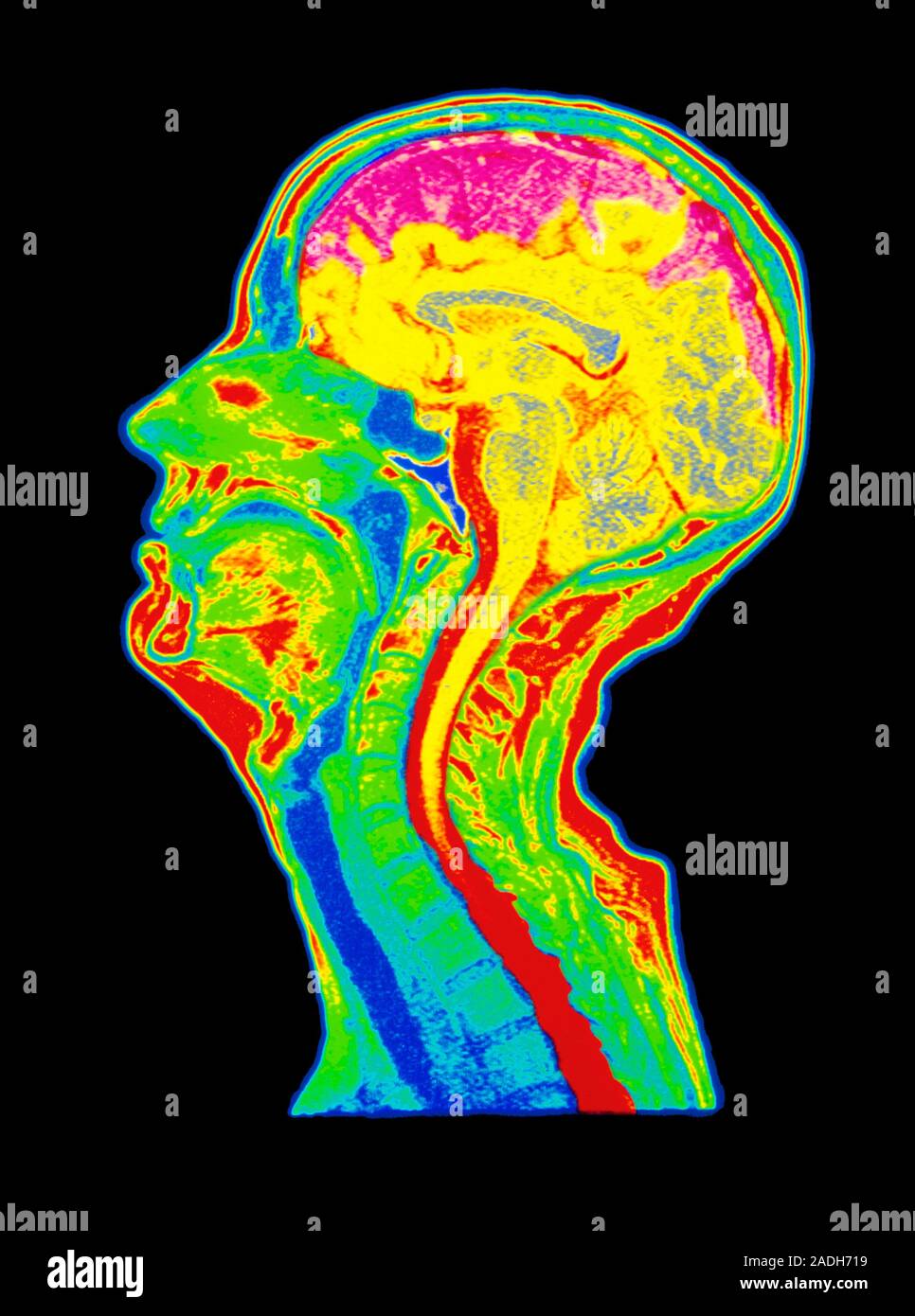 Brain atrophy. Coloured magnetic resonance imaging (MRI) scan of a ...