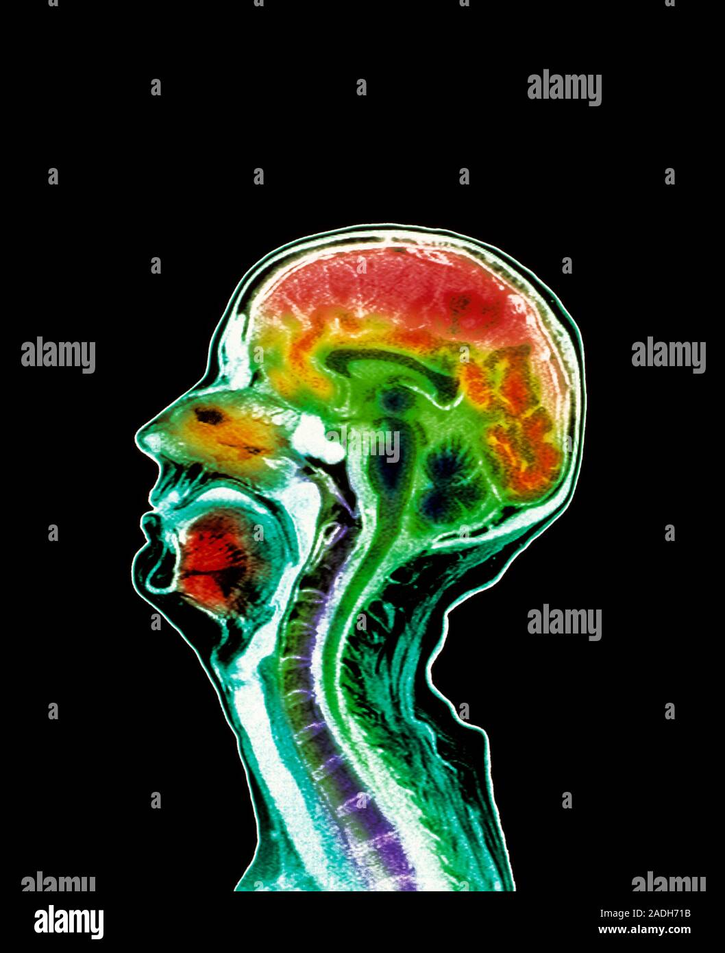 Brain atrophy. Coloured magnetic resonance imaging (MRI) scan of a sagittal section through the ...