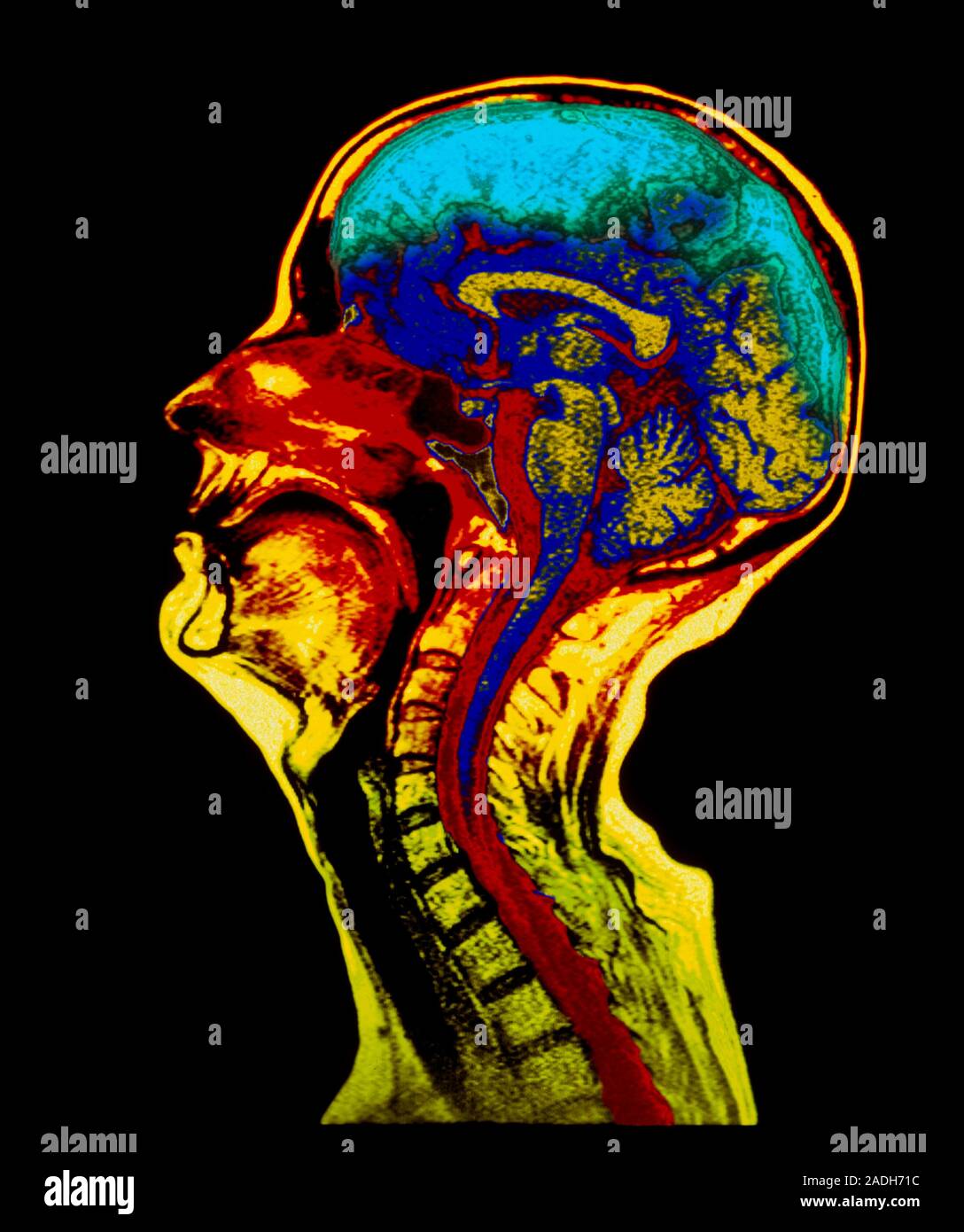 Brain atrophy. Coloured magnetic resonance imaging (MRI) scan of a ...