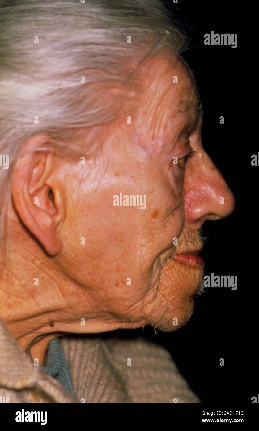 Acromegaly. Profile of a 90 year old woman's face showing the symptoms ...