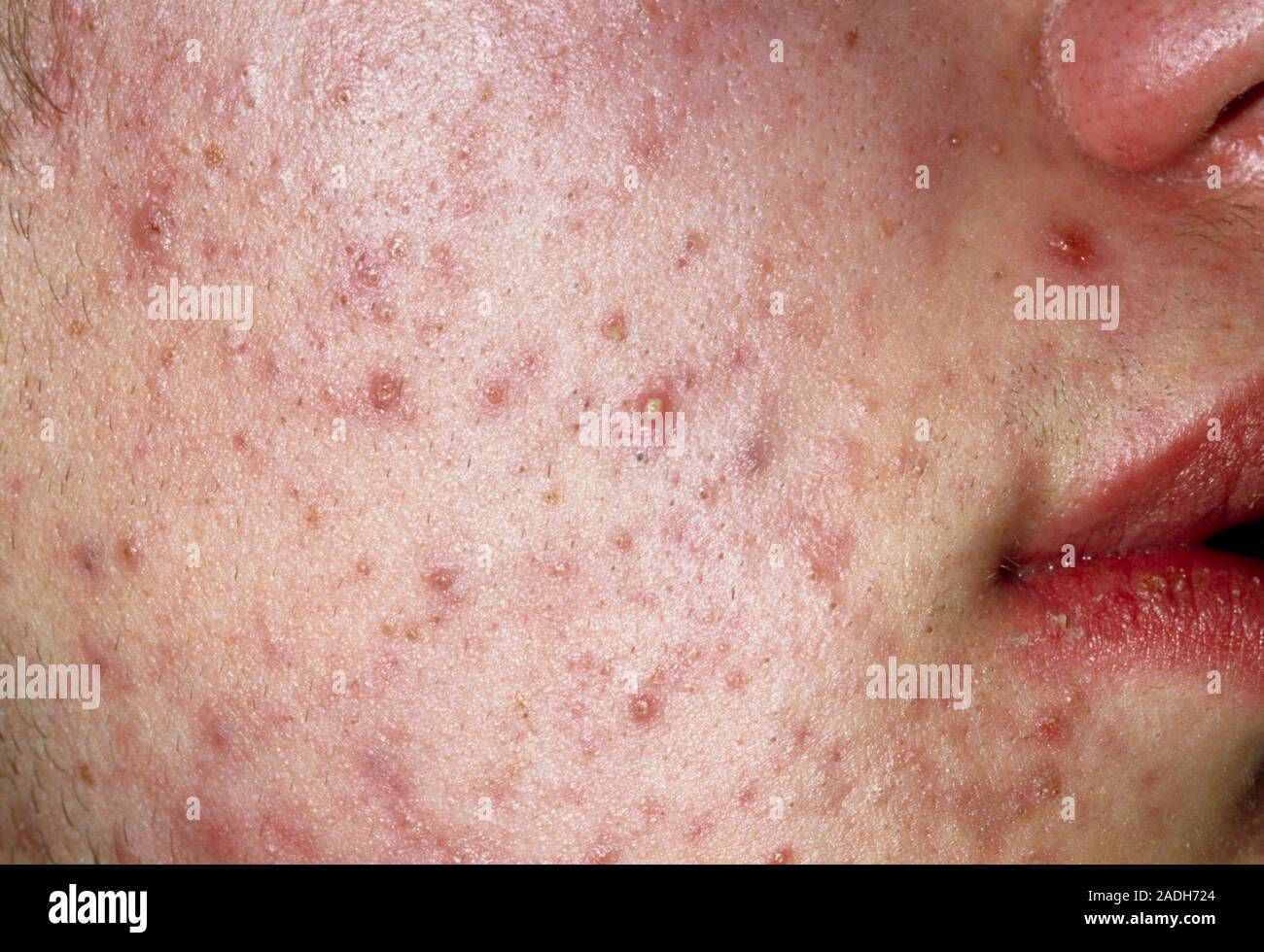 Acne vulgaris. Acne on the skin of the face of a 15 year old boy. Acne ...