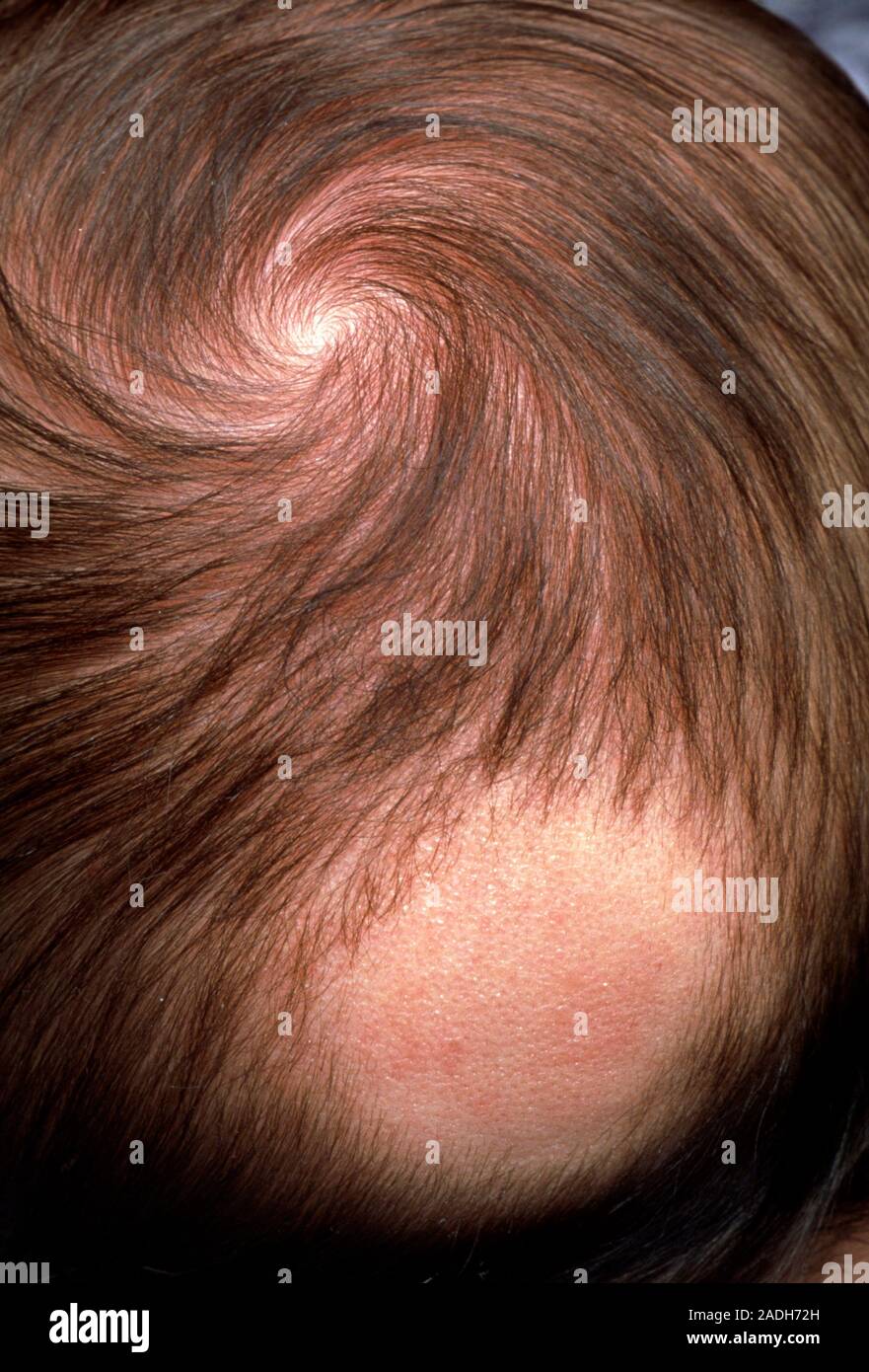 Baby's bald patch. Hair loss on the back of a 3 month old baby's head ...