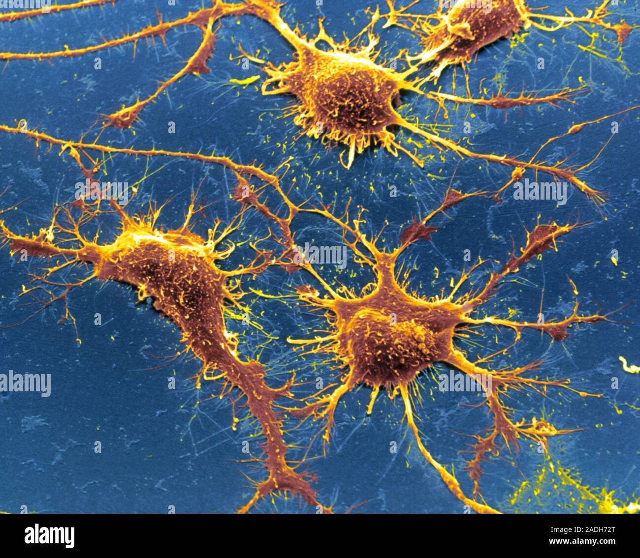 Alzheimer's disease culture cells. Coloured scanning electron ...