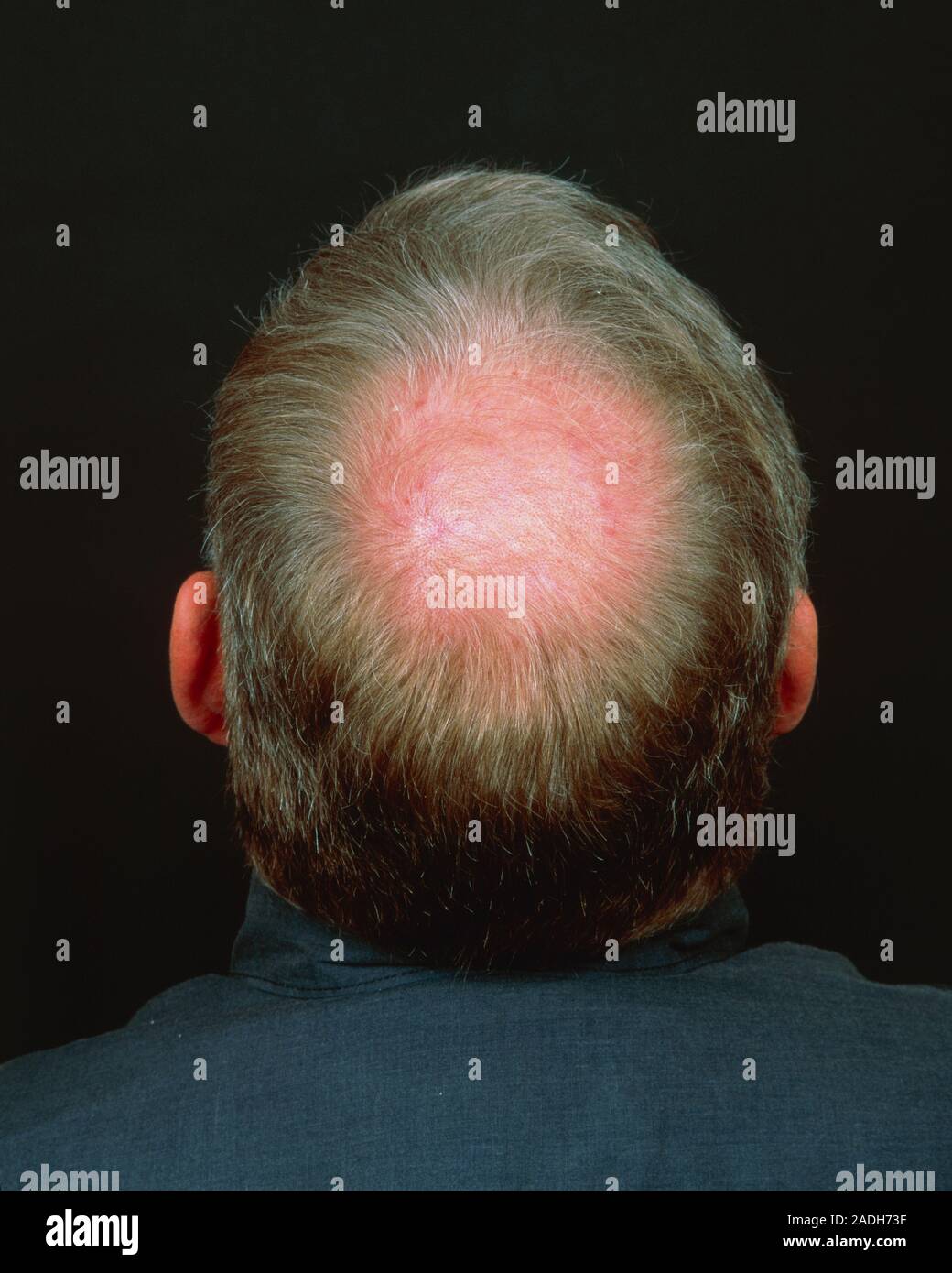 Baldness. Back view of a man's balding head. This type of hair loss ...