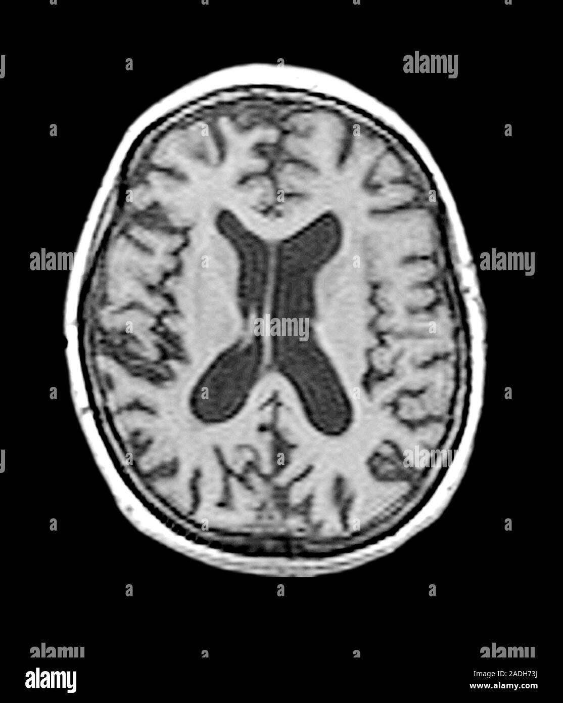 Alzheimer's disease. Magnetic resonance imaging (MRI) scan of an axial ...
