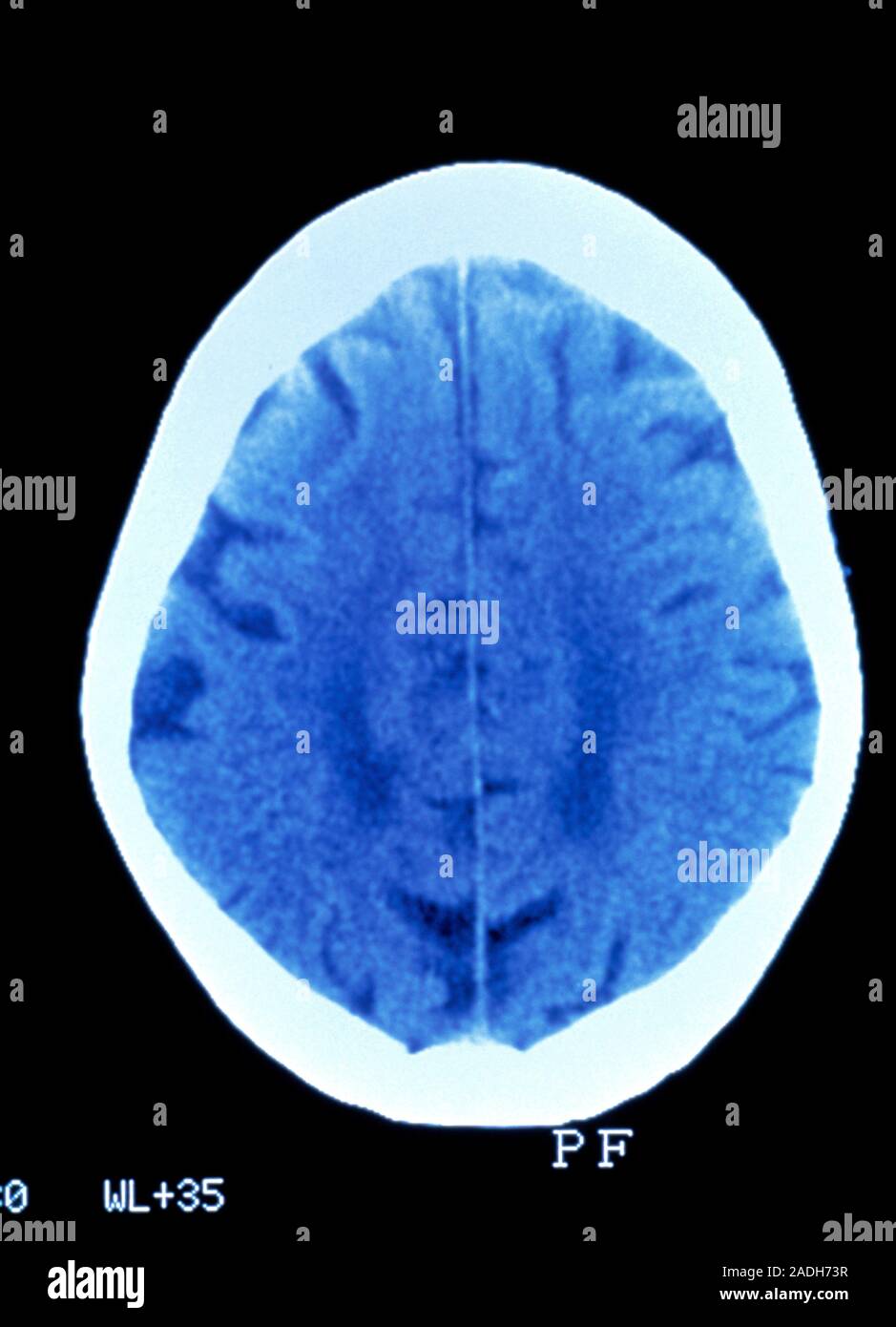 Multi-infarct dementia. Coloured computed tomography (CT) scan of an ...