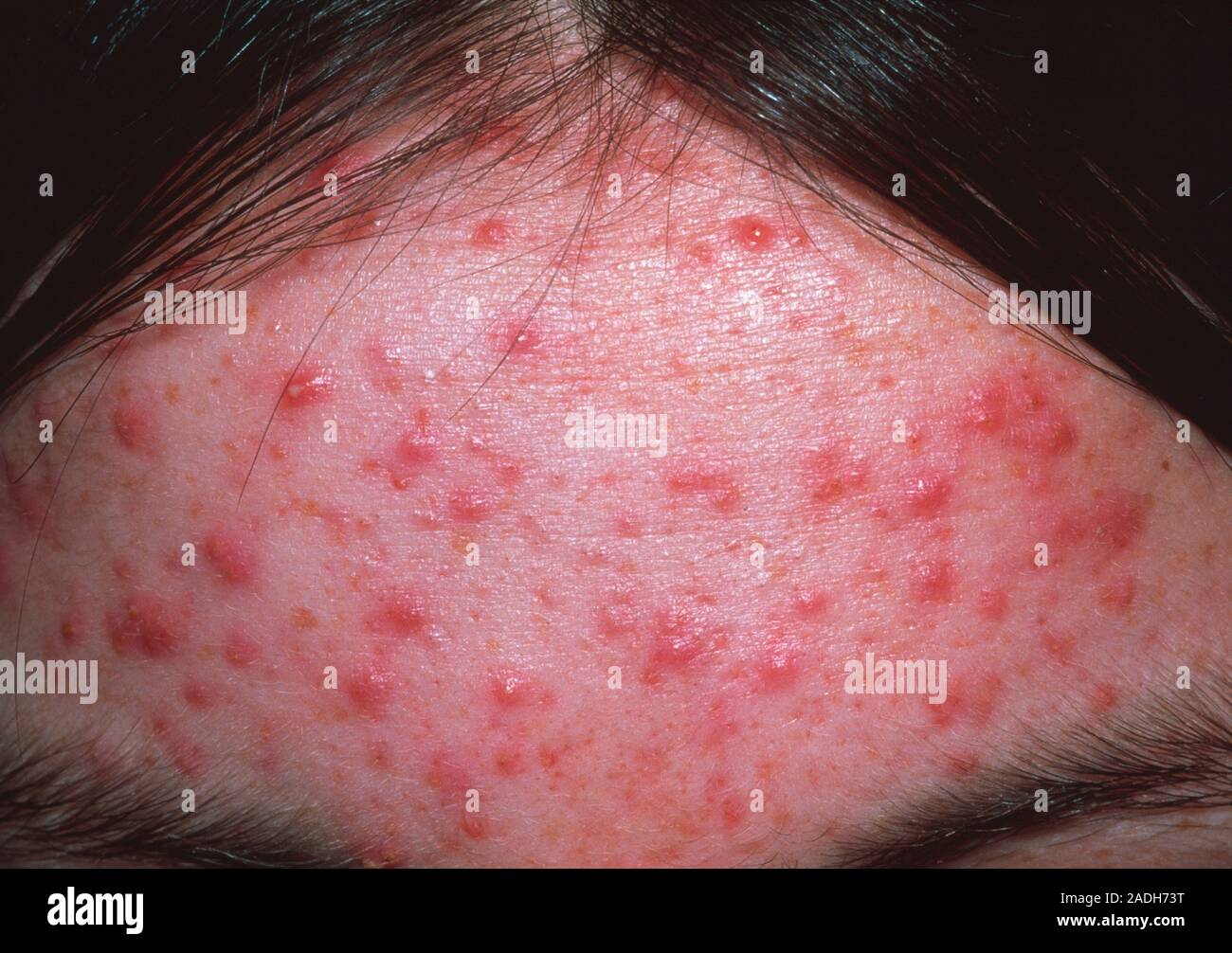 Acne vulgaris on the forehead of a 15-year-old girl. Acne is a general ...