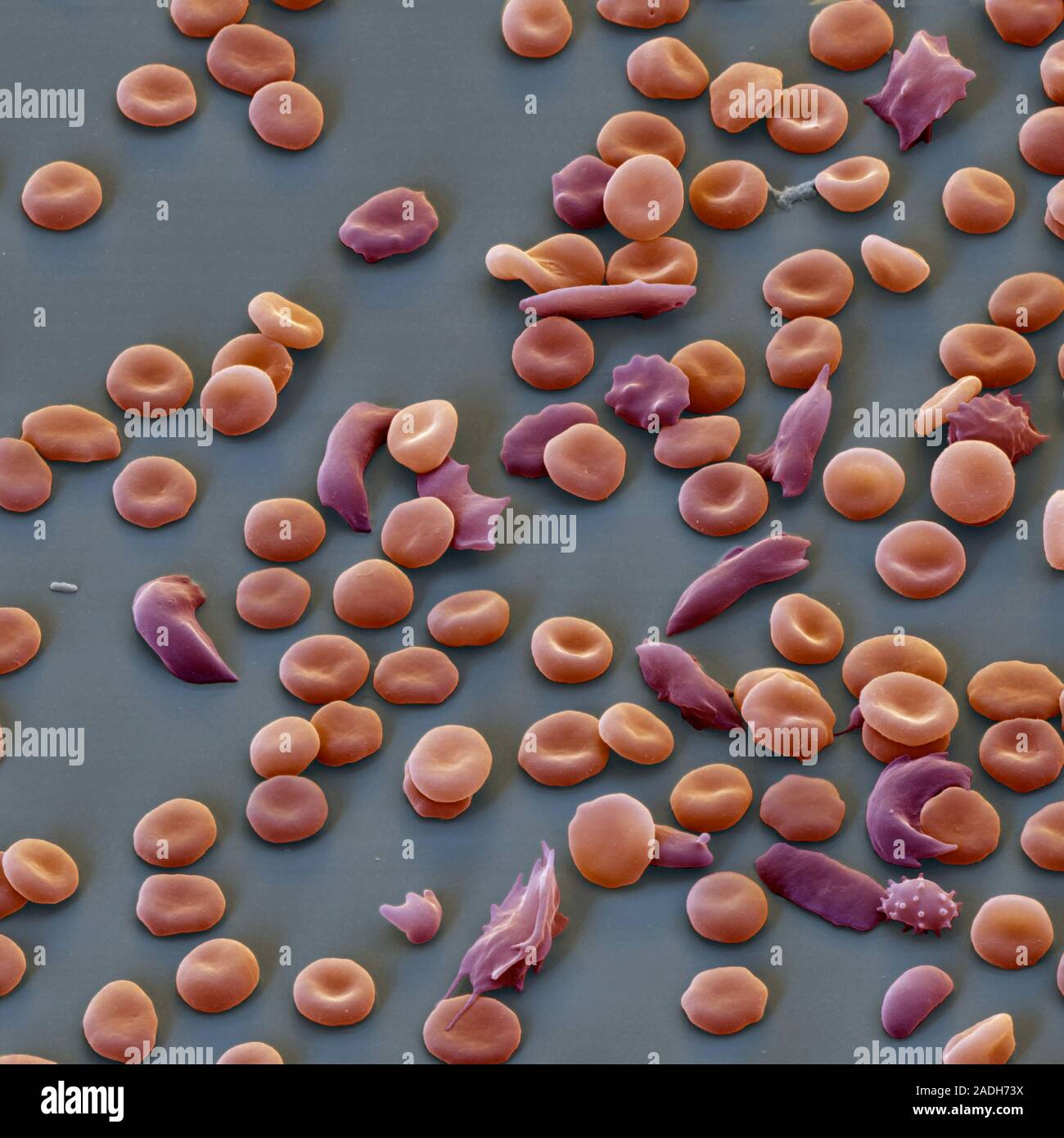 Sickle cell anaemia. Coloured scanning electron micrograph (SEM) of red ...