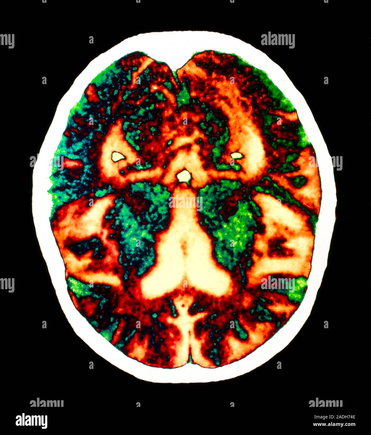 Alzheimer's disease. Coloured computed tomography (CT) scan of an axial (horizontal) section ...