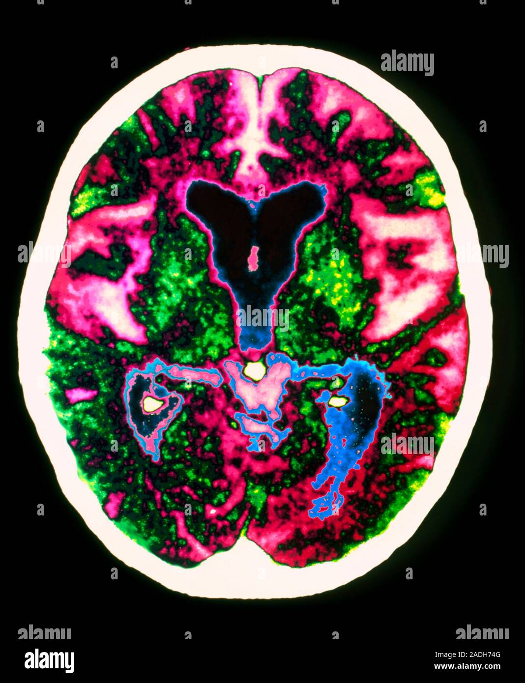 Alzheimer's disease. Coloured computed tomography (CT) scan of an axial (horizontal) section ...