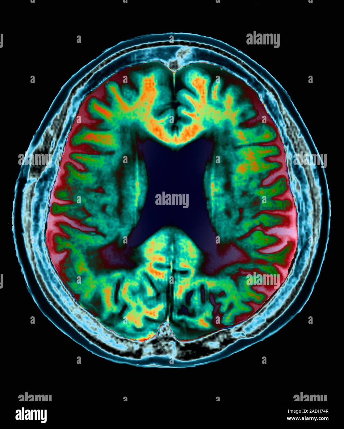 Alzheimer's disease. Coloured magnetic resonance imaging (MRI) scan of ...