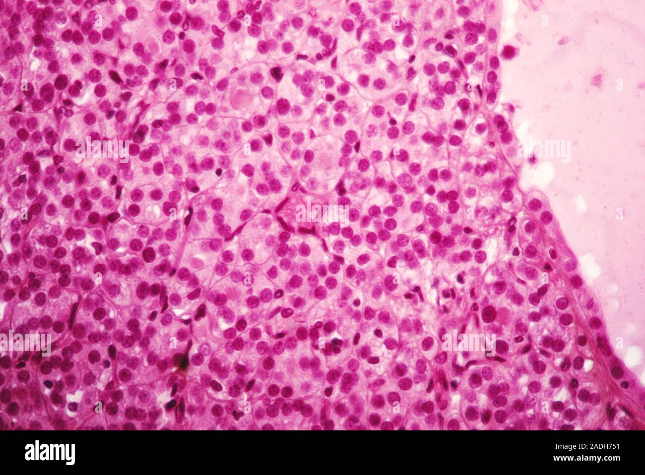 Parathyroid gland adenoma. Light micrograph of a section through a ...