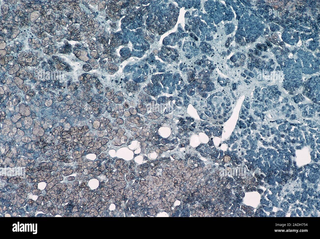 Adrenal gland adenoma. Light micrograph of a section through an adrenal ...