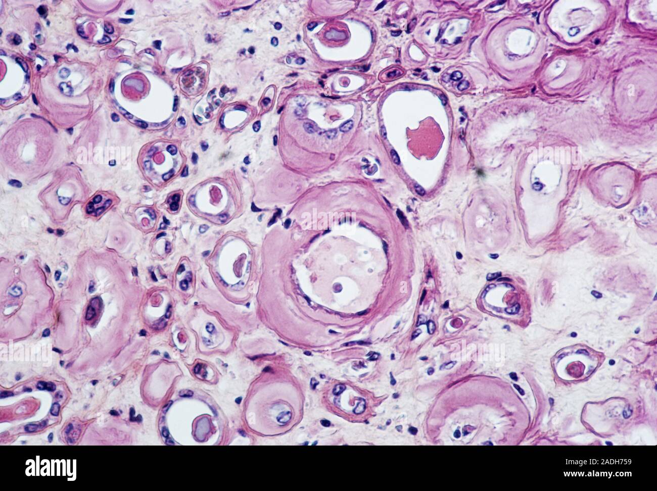 Amyloidosis. Light micrograph of a section through kidney tissue in a ...