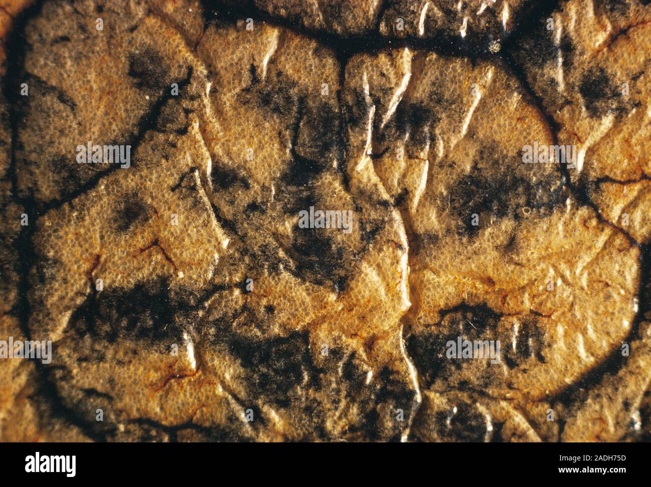 Coal dust in lungs. Gross clinical specimen of coal dust (black) in ...