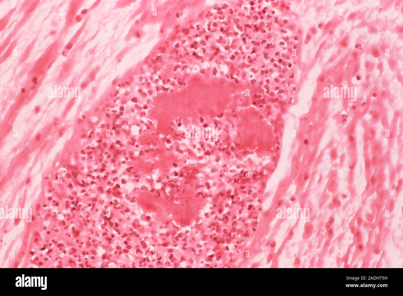 Bacterial lung infection. Light micrograph of a section through lung ...