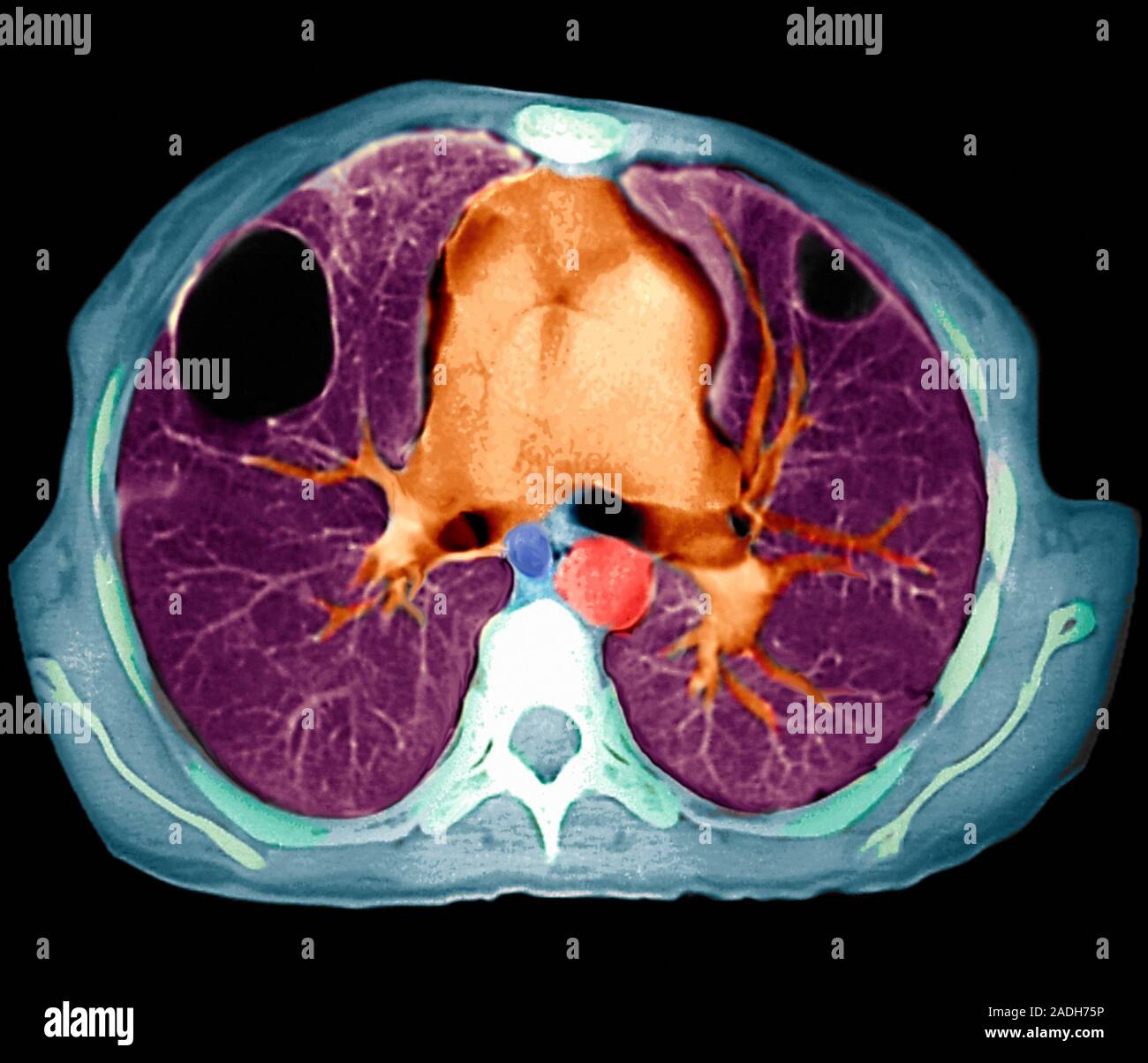 Lung abscesses. Coloured computed tomography (CT) scan through a ...