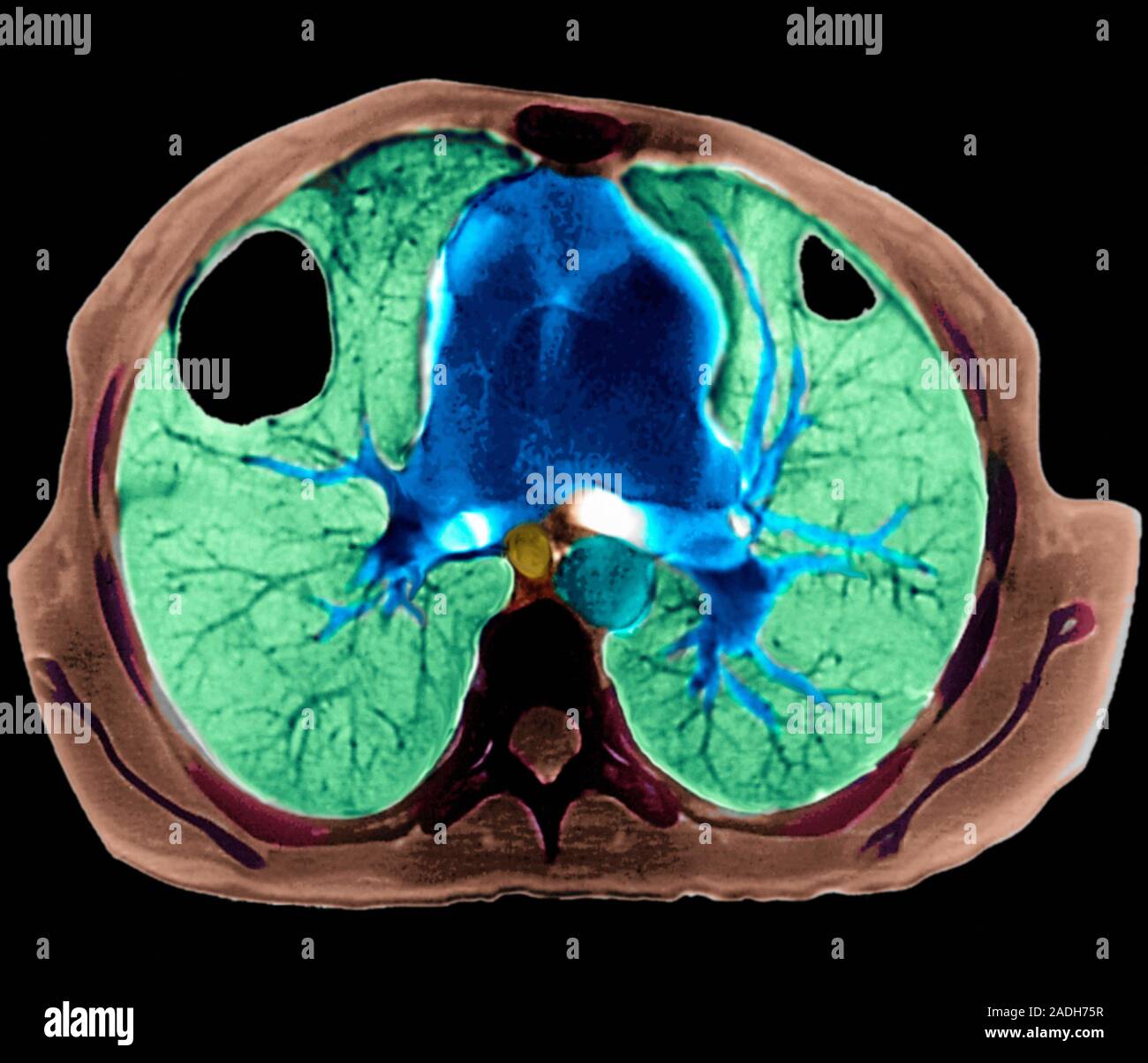 Lung abscesses. Coloured computed tomography (CT) scan through a ...