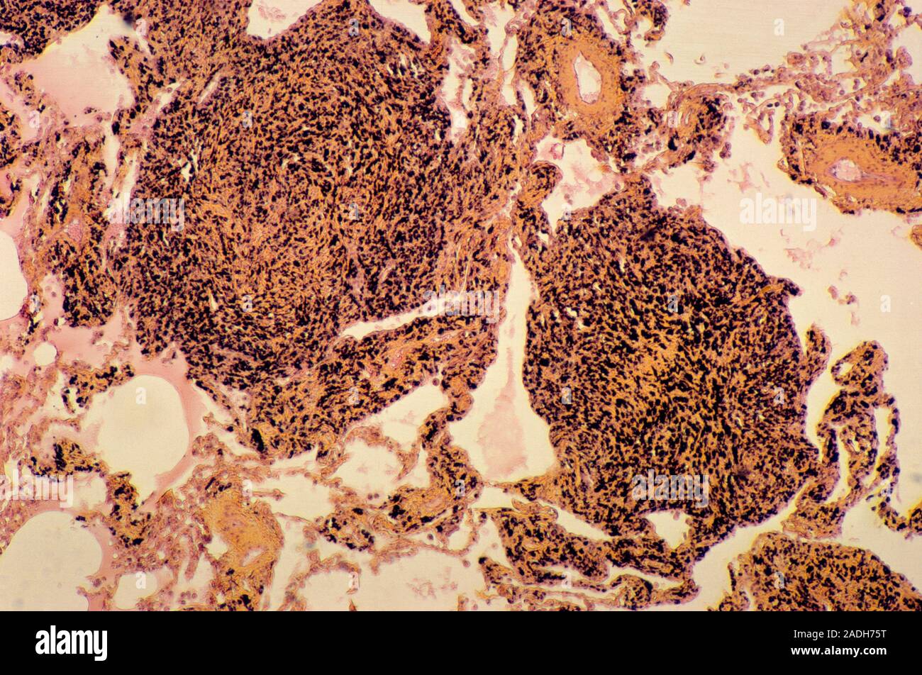 Coal dust inhalation. Light micrograph of a section through lung tissue ...