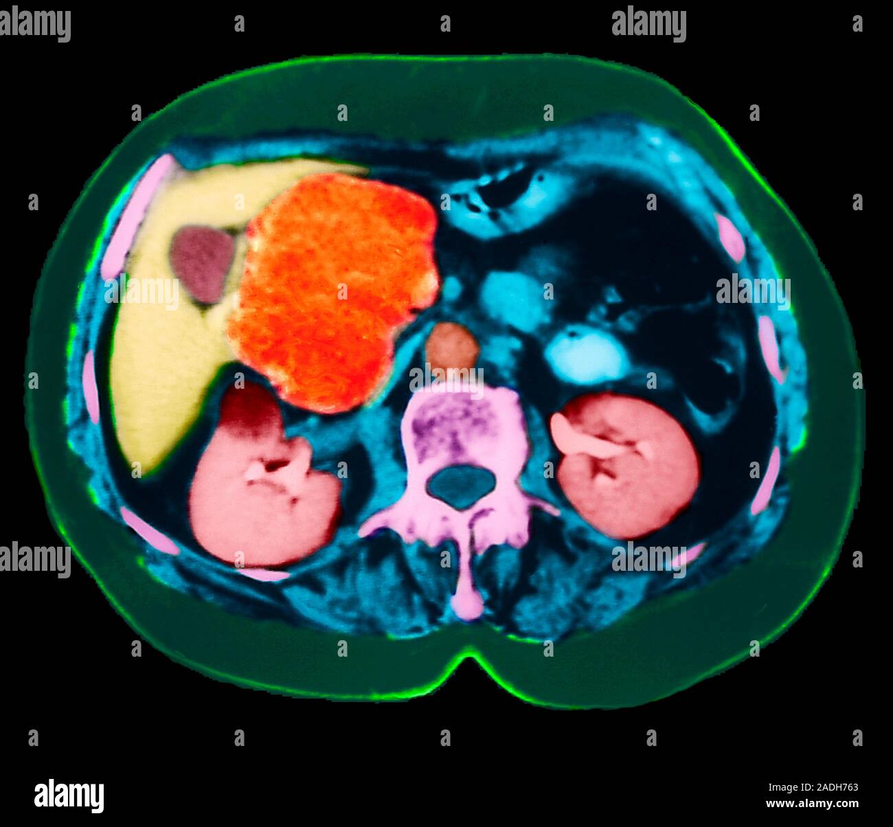 Cystic pancreas tumour. Coloured computed tomography (CT) scan through ... Cystic pancreas tumour. Coloured computed tomography (CT) scan through ...