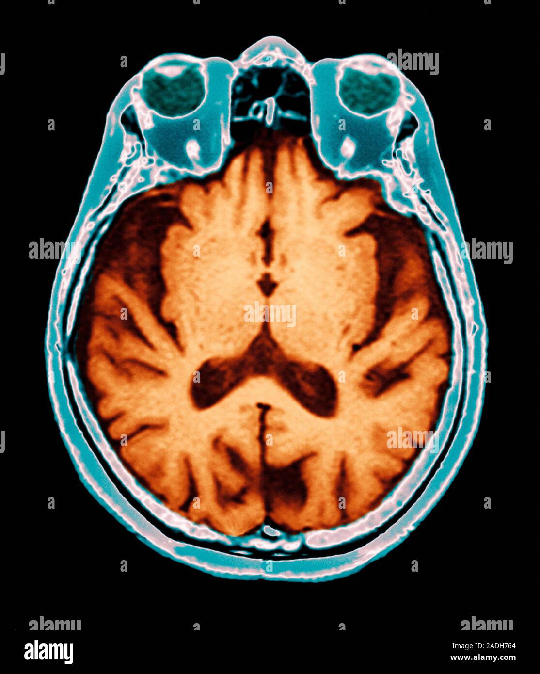 Alzheimer's disease. Coloured axial magnetic resonance imaging (MRI ...