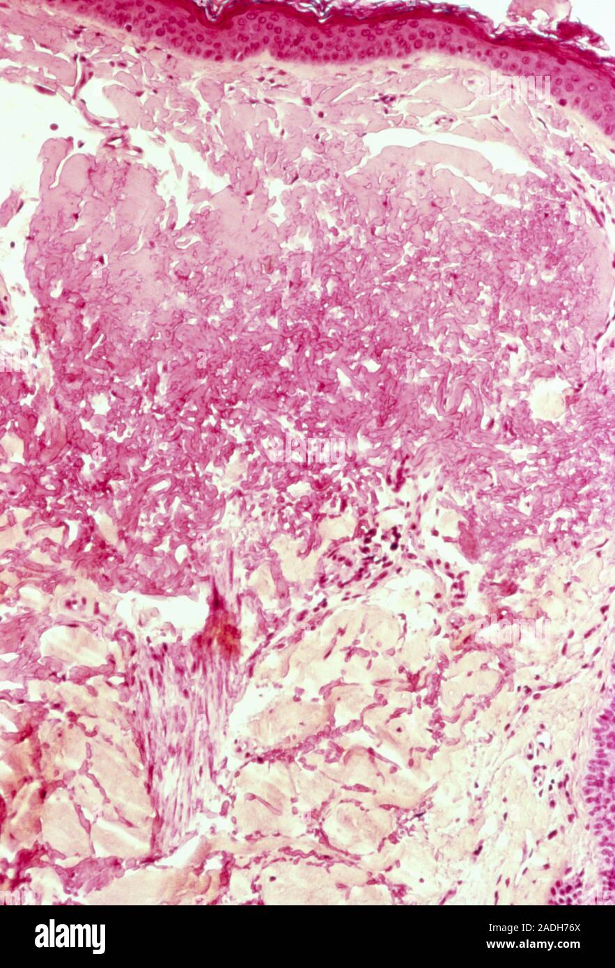 Skin deposits. Light micrograph of a section through skin showing ...