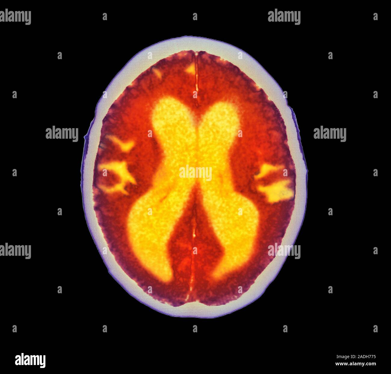 Alzheimer's disease brain, coloured computed tomography (CT) scan. This ...