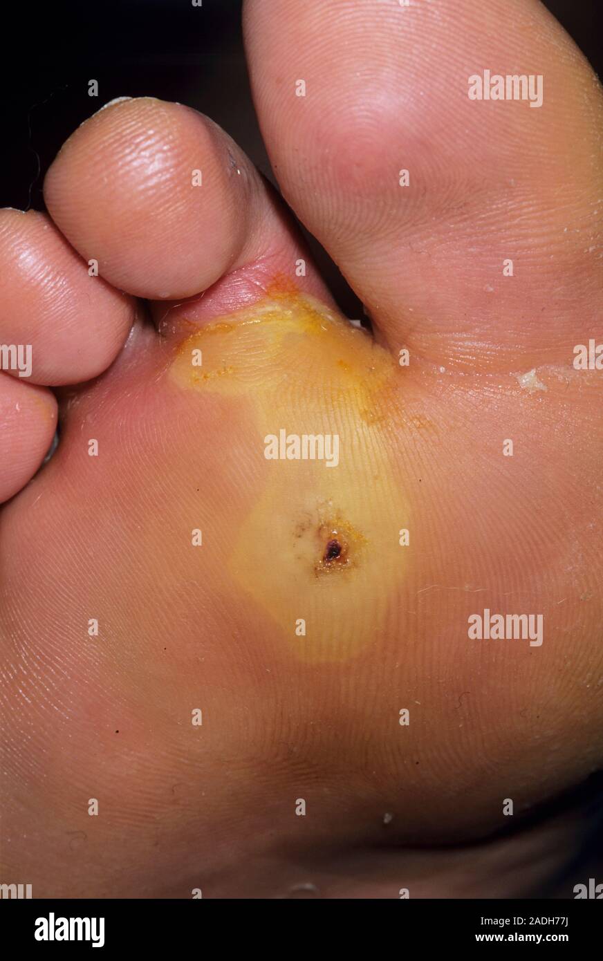 Infected abscess on the sole of the foot of a 64 year old man. An ...