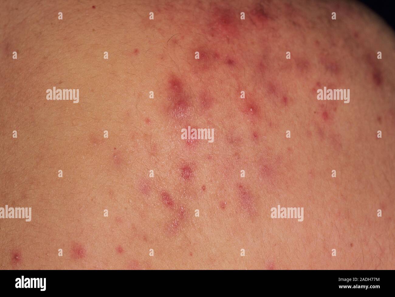 Acne vulgaris on a 24-year-old man's back. Acne is a general name given ...