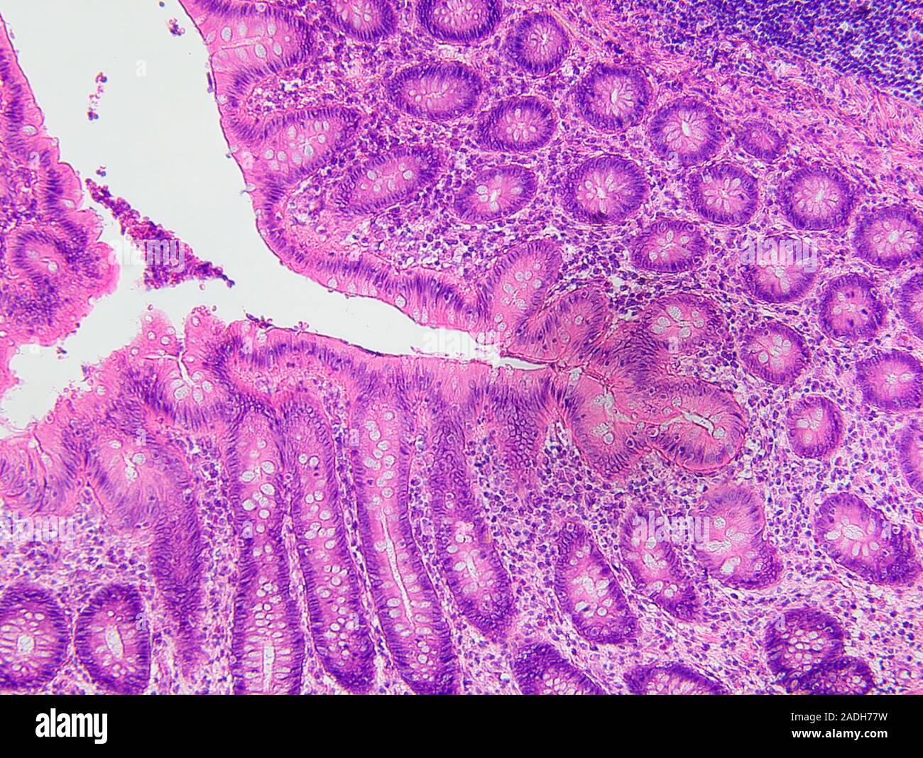 Acute appendicitis. Coloured light micrograph (LM) through a section of ...