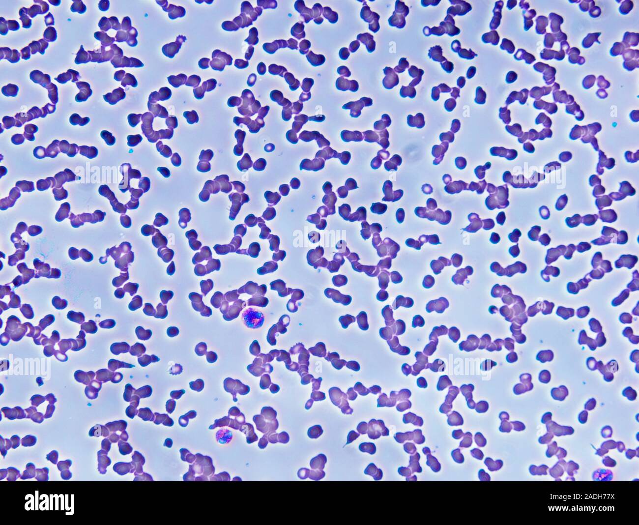 Pernicious anaemia. Coloured light micrograph (LM) of a blood smear ...