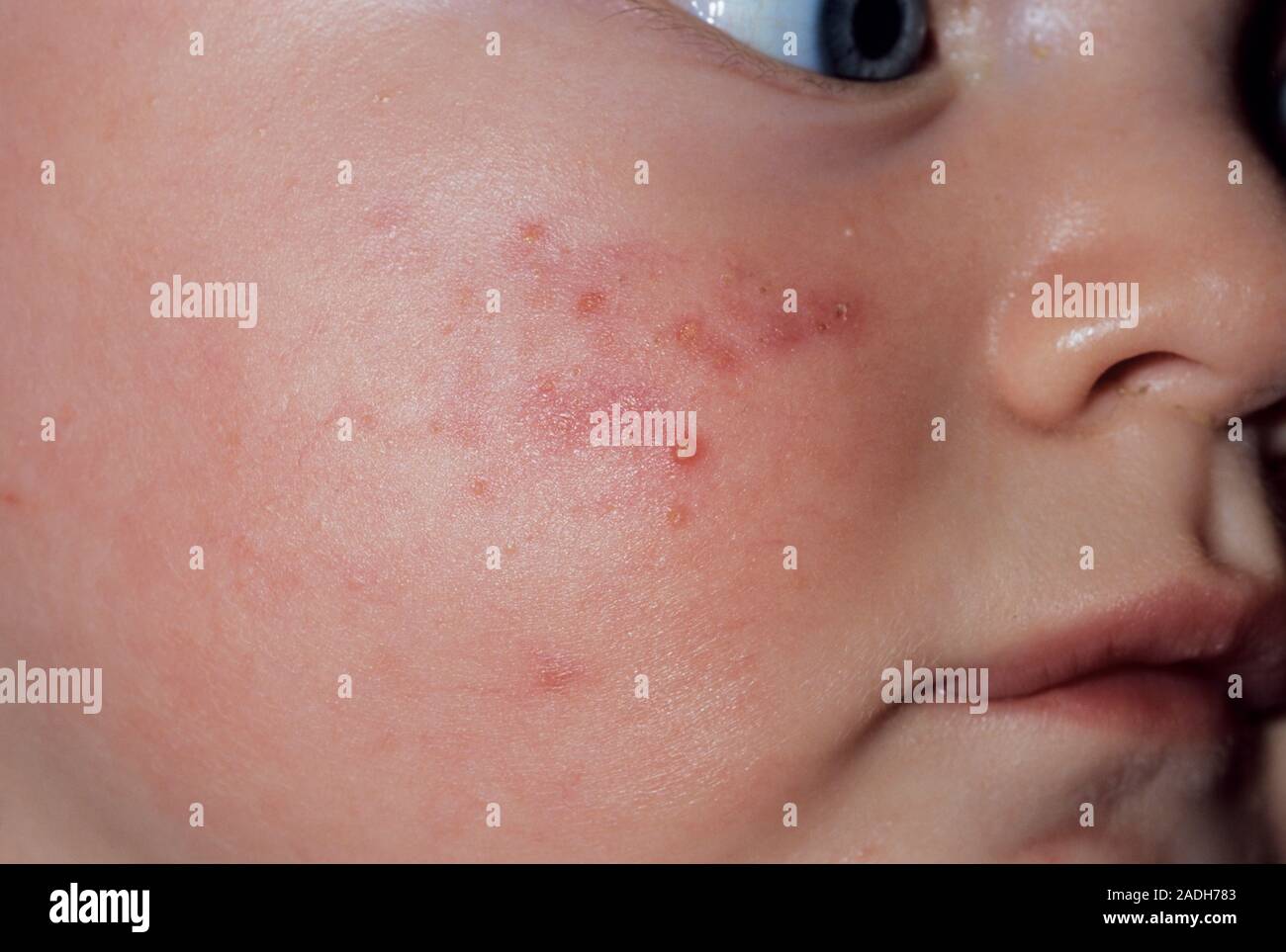 MODEL RELEASED. Infantile acne. Cheek of a 6- month-old boy with ...
