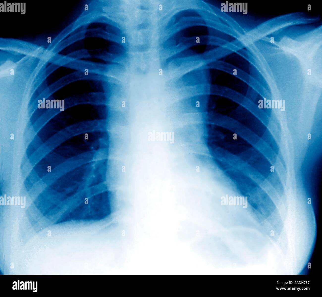 Mediastinal adenopathy. X-ray of the chest of a patient with bilateral ...