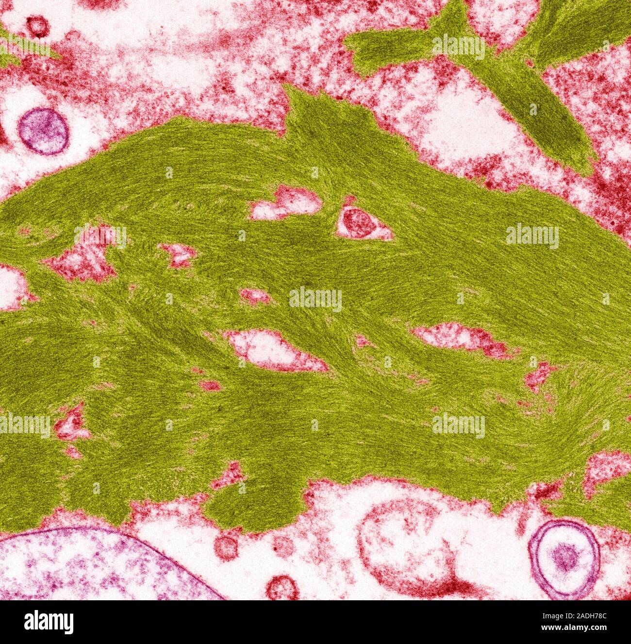 Amyloidosis. Coloured transmission electron micrograph (TEM) of a ...