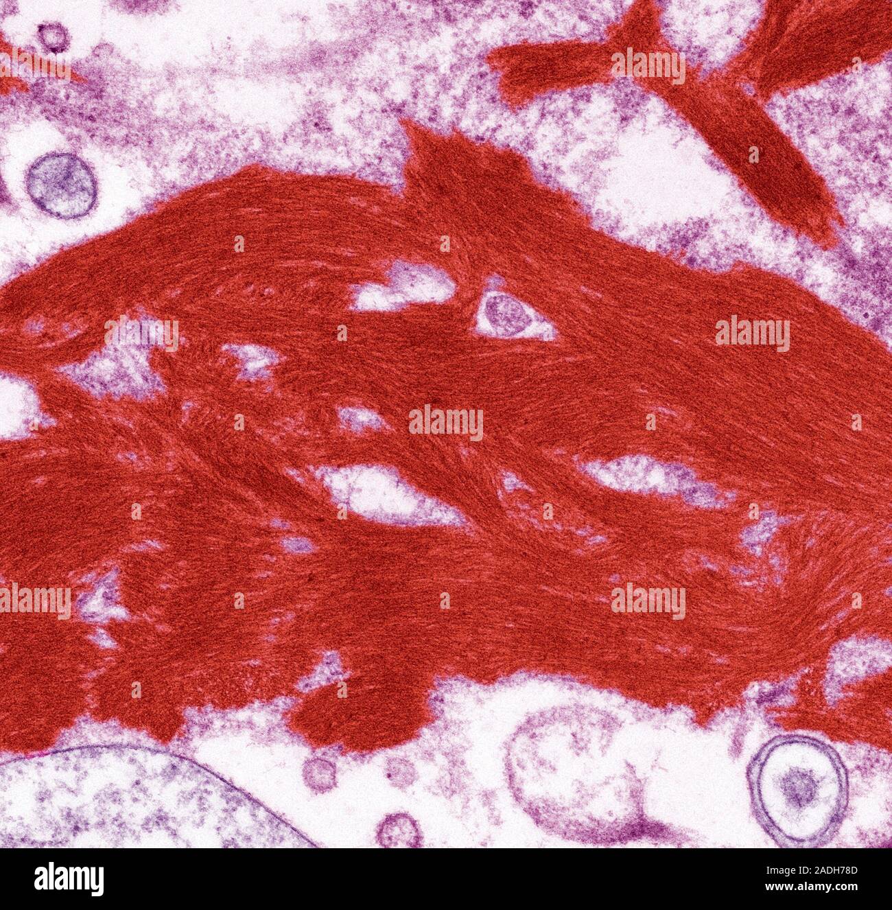Amyloidosis. Coloured transmission electron micrograph (TEM) of a ...