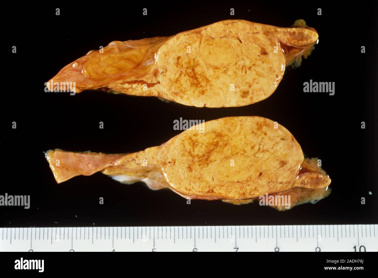 Adrenal Gland Tumour Gross Specimen This Is An Adenoma Of The Cortex Outer Lining Of The
