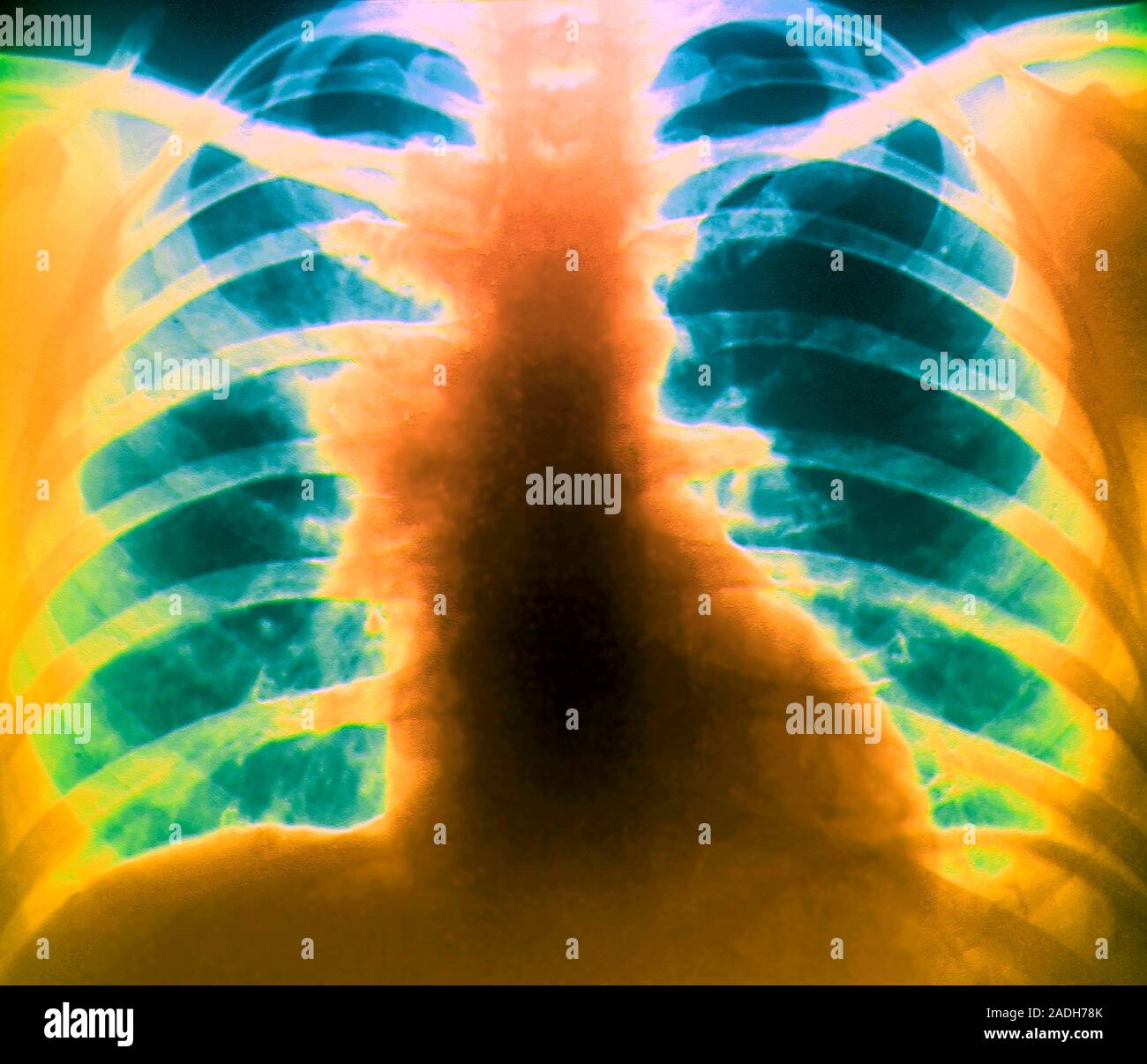 Mediastinal adenopathy. Coloured frontal X-ray of the chest of a ...