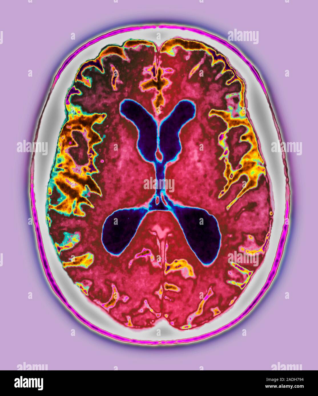 Alzheimer's disease. Coloured axial magnetic resonance imaging (MRI ...