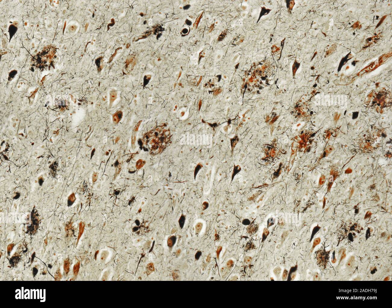 Alzheimer's disease brain tissue, light micrograph. Two characteristic ...