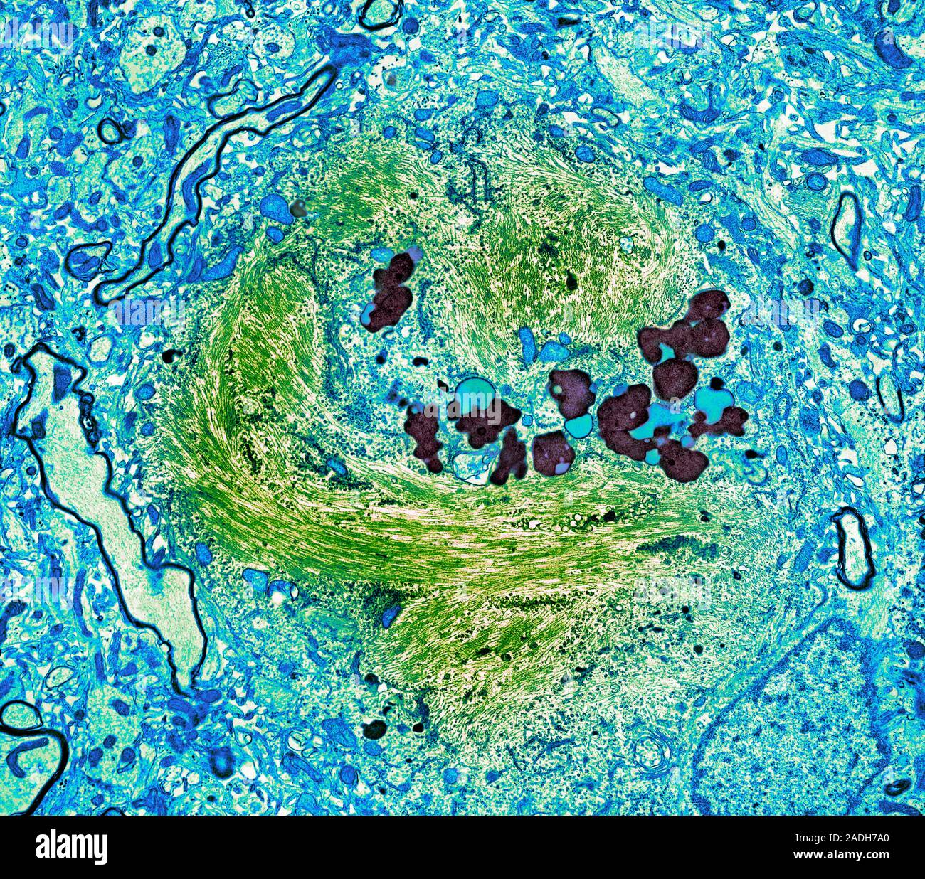 Alzheimer's disease brain cell. Coloured transmission electron ...
