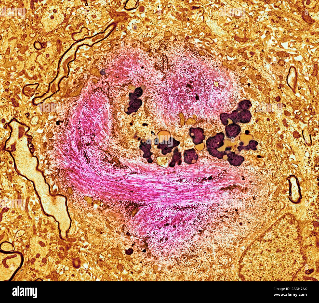 Alzheimer's disease brain cell. Coloured transmission electron ...