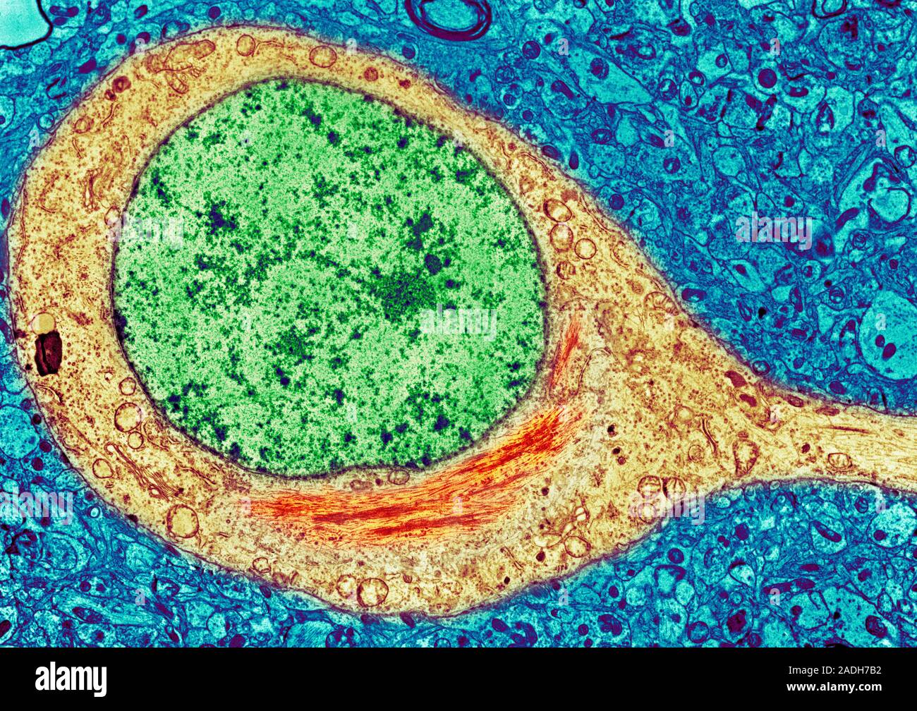 Alzheimer's disease brain cell. Coloured transmission electron ...