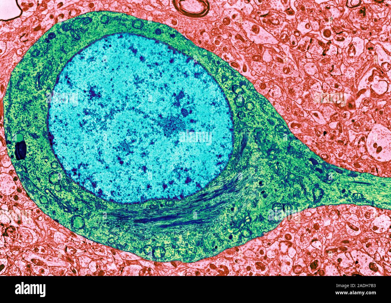 Alzheimer's disease brain cell. Coloured transmission electron ...