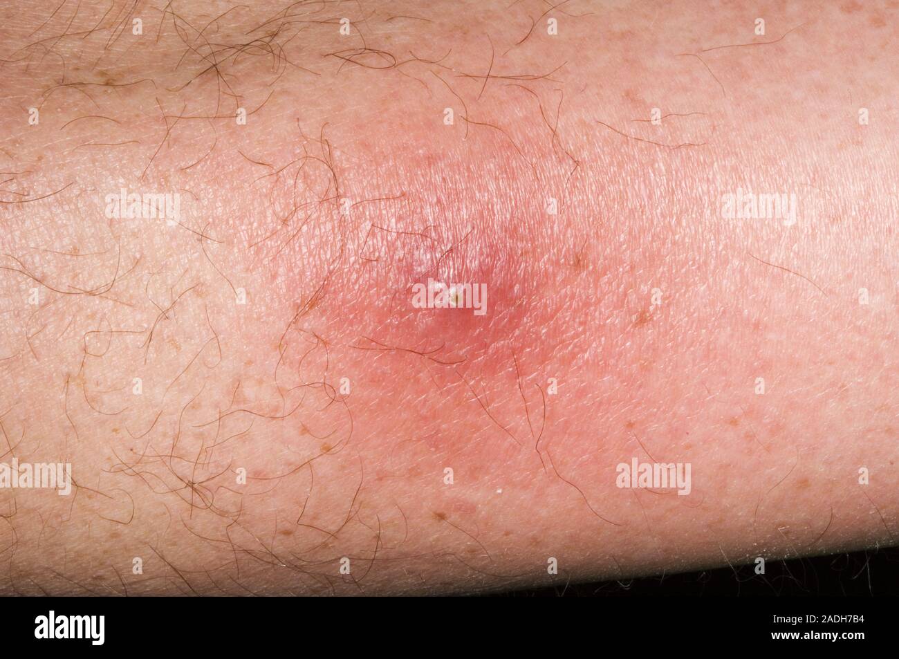 Abscess on a 64 year old man's limb. An abscess is a painful pus-filled ...