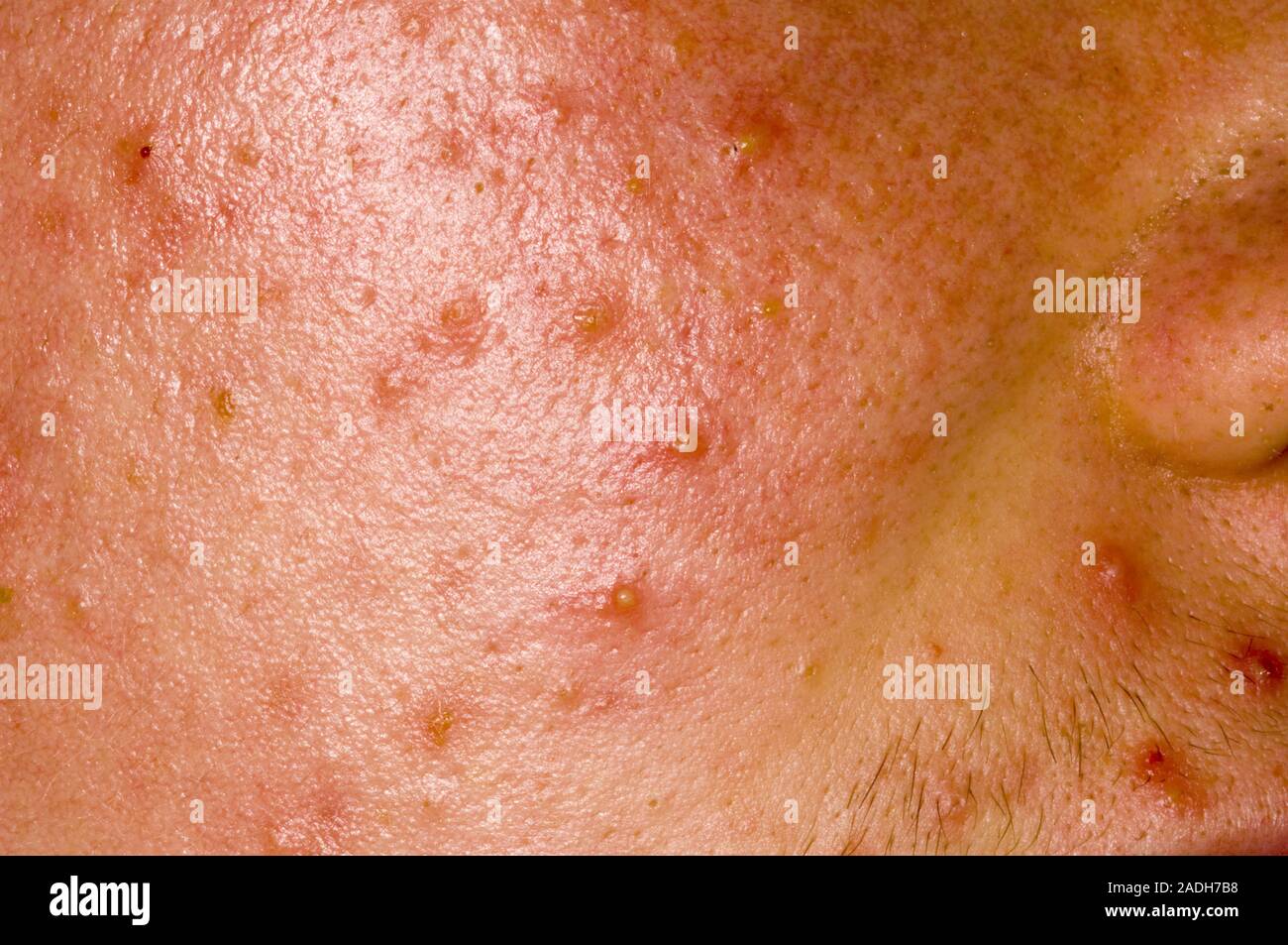 Acne vulgaris on a 15 year old boy's face. Acne is a general name given ...