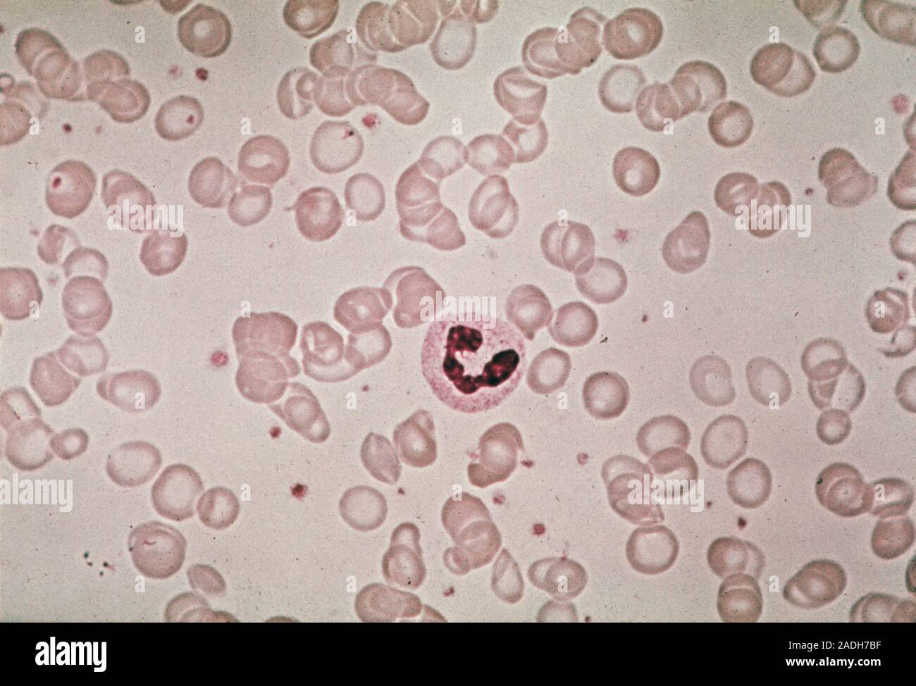 Anaemia. Light micrograph of a blood smear from a patient with ...