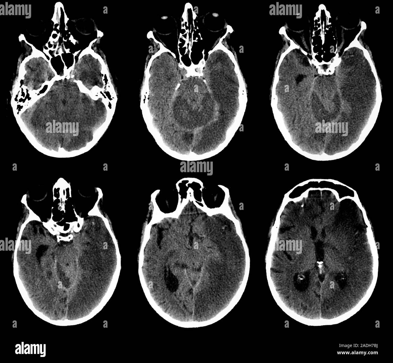 Alzheimer's disease. Series of computed tomography (CT) scans of an ...